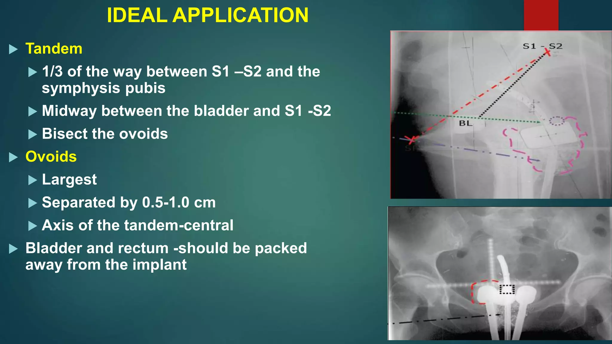 Evolution of Intracavitary brachytherapy for carcinoma of cervix | PPTX