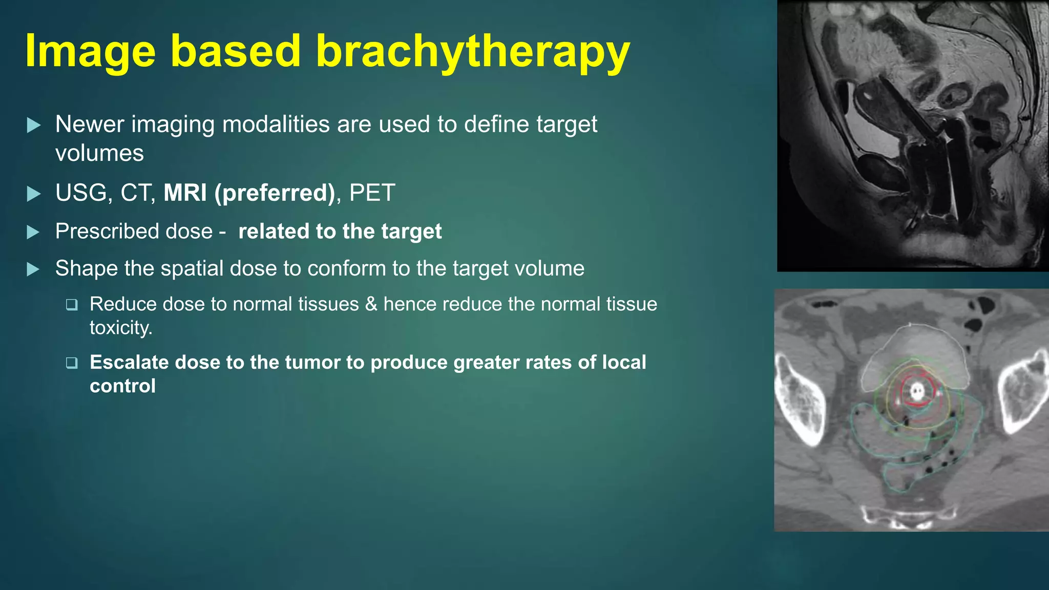Evolution of Intracavitary brachytherapy for carcinoma of cervix | PPTX