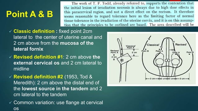 Evolution of Intracavitary brachytherapy for carcinoma of cervix | PPTX ...