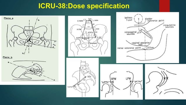 Evolution of Intracavitary brachytherapy for carcinoma of cervix | PPTX ...