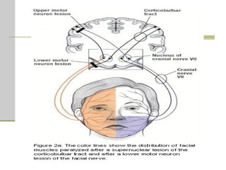 Facial Nerve Palsy Upper Motor Neuron