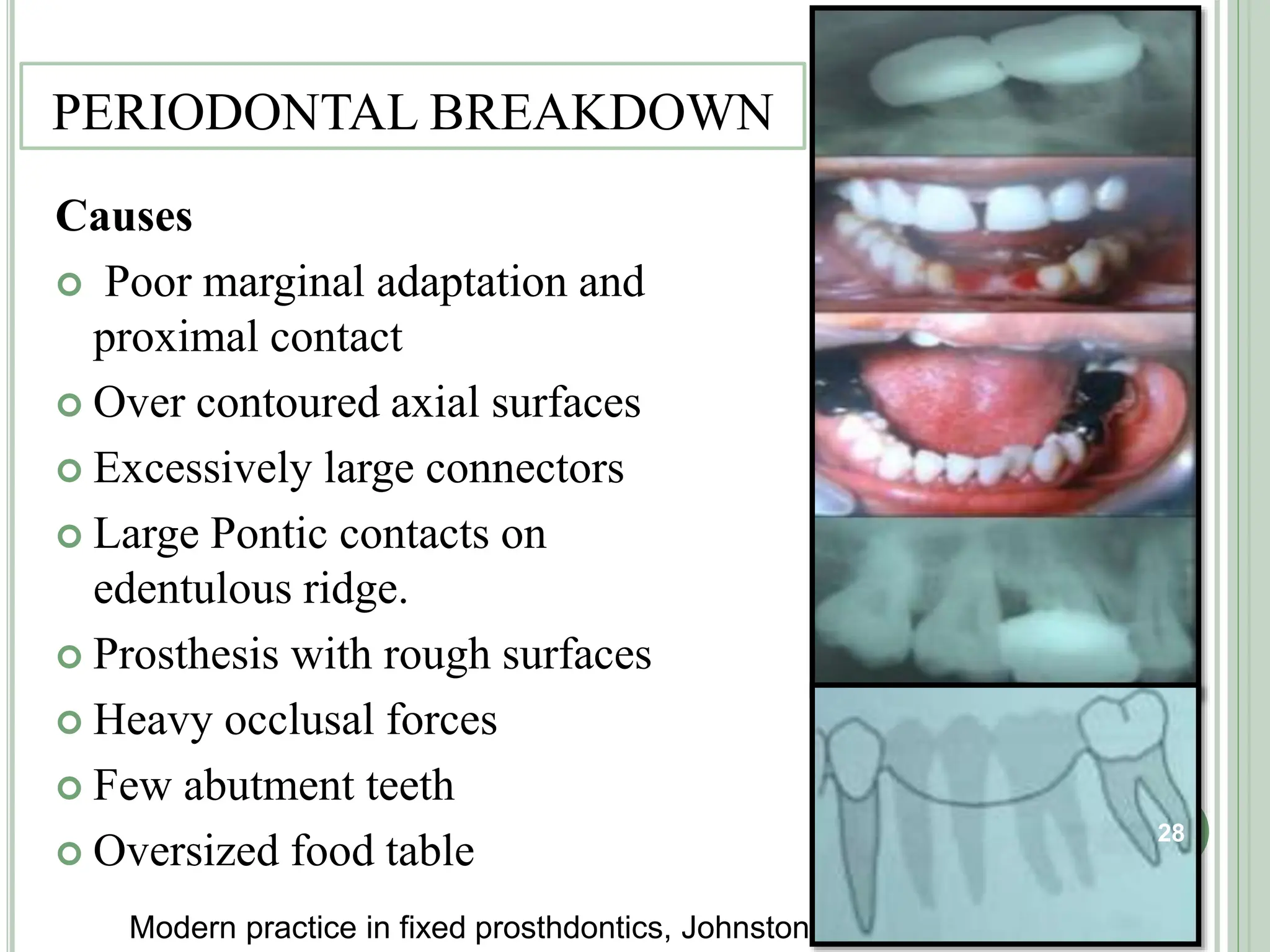 Final failures in fixed partial denture Richa.pptx