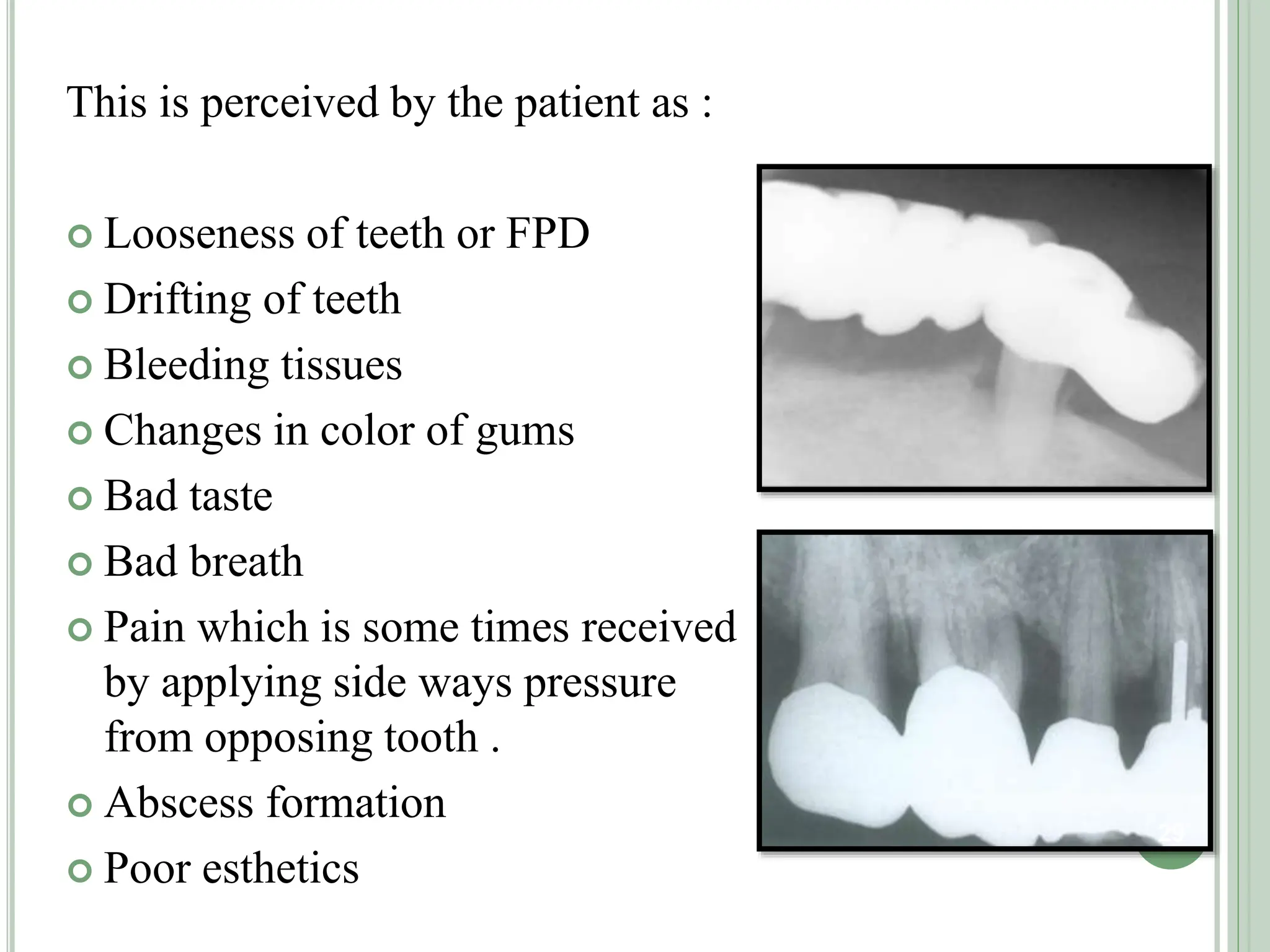 Final failures in fixed partial denture Richa.pptx