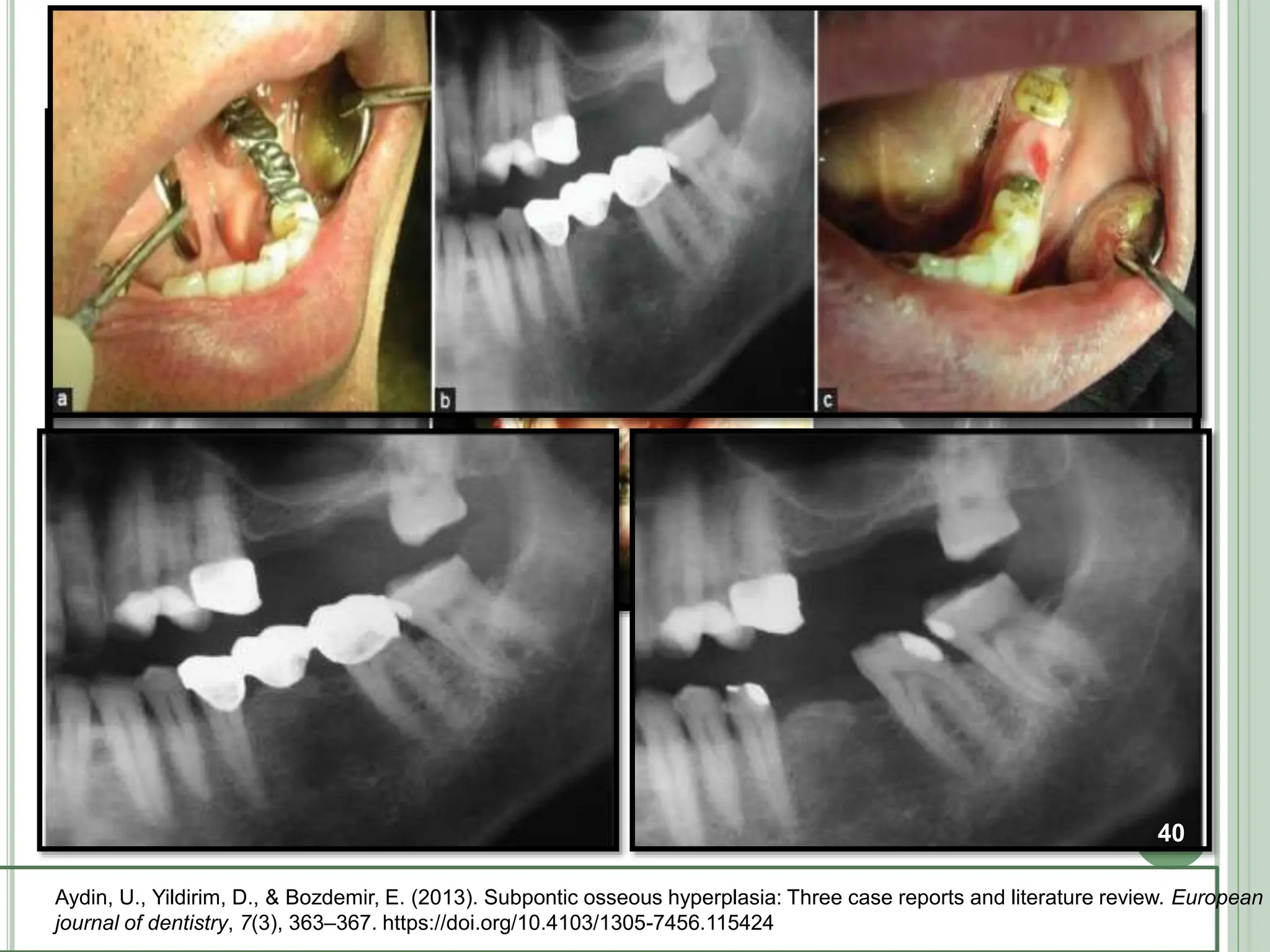 Final failures in fixed partial denture Richa.pptx