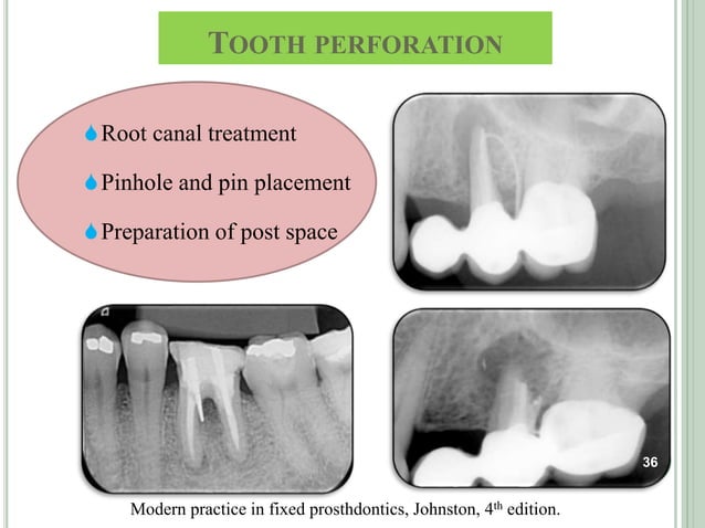 Final failures in fixed partial denture Richa.pptx | Dental Health ...