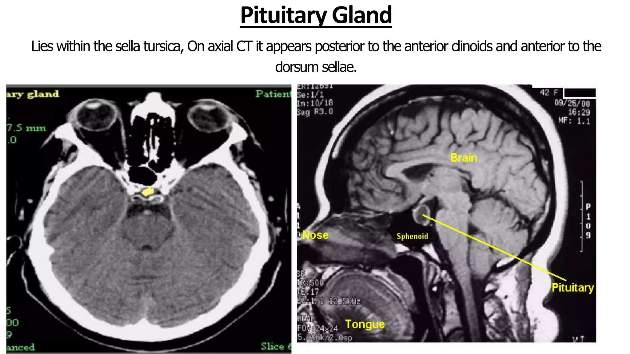 Radiological anatomy of brain | PPTX