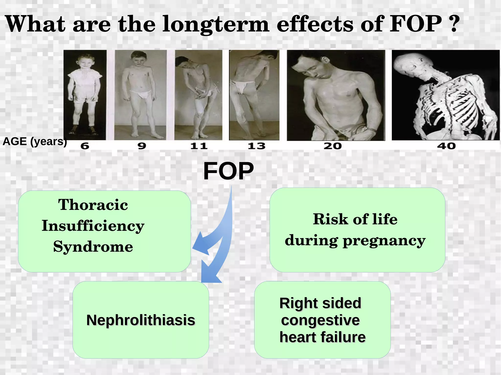 Fibrodysplasia ossificans progressiva | PDF