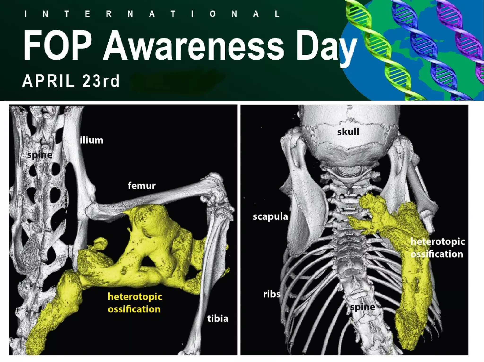 Fibrodysplasia ossificans progressiva | PDF