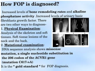 Fibrodysplasia ossificans progressiva | PDF