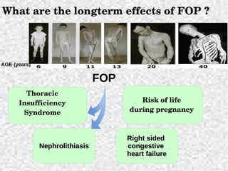 Fibrodysplasia ossificans progressiva | PDF