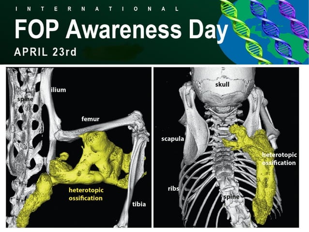 Fibrodysplasia ossificans progressiva | PDF