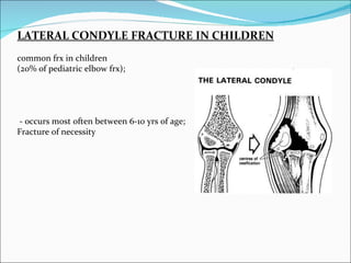 Lateral Condyle