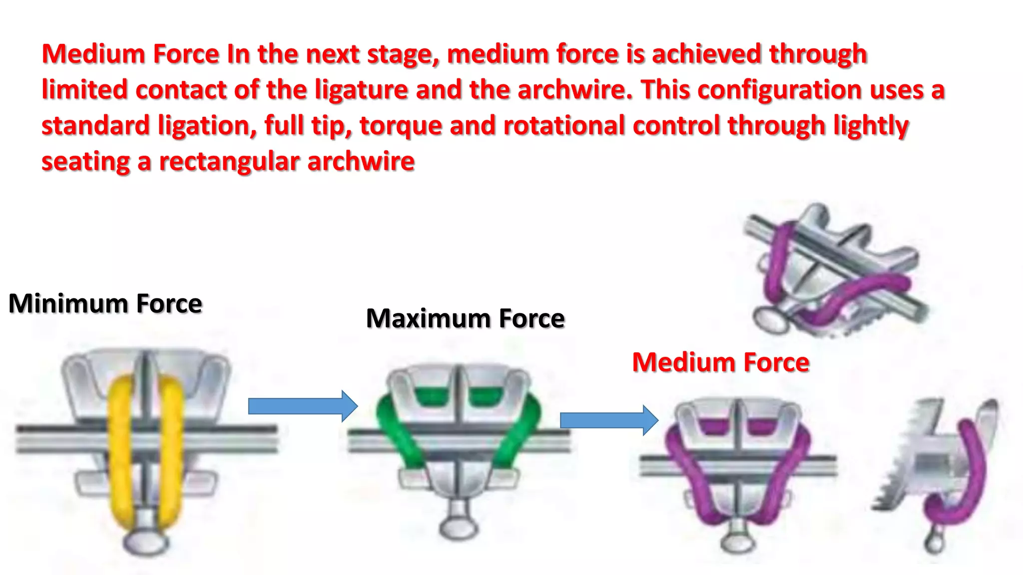 Methods of ligation | PPTX