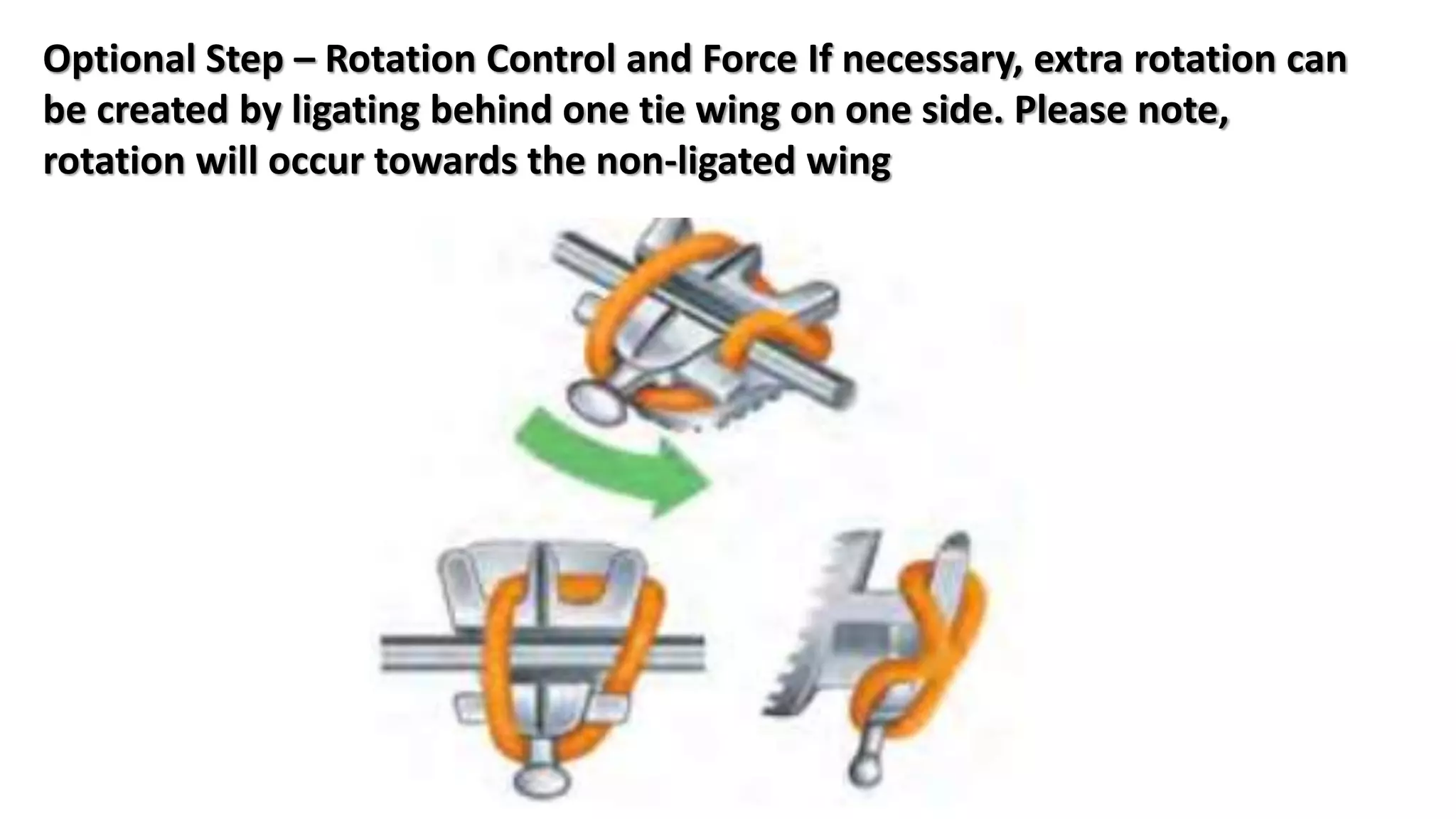 Methods of ligation | PPTX