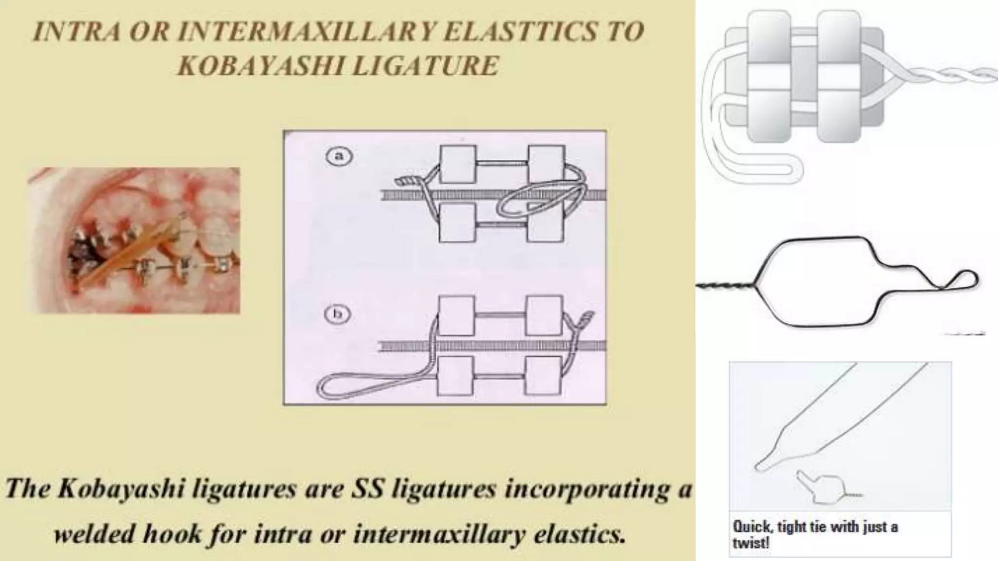 Methods of ligation | PPTX