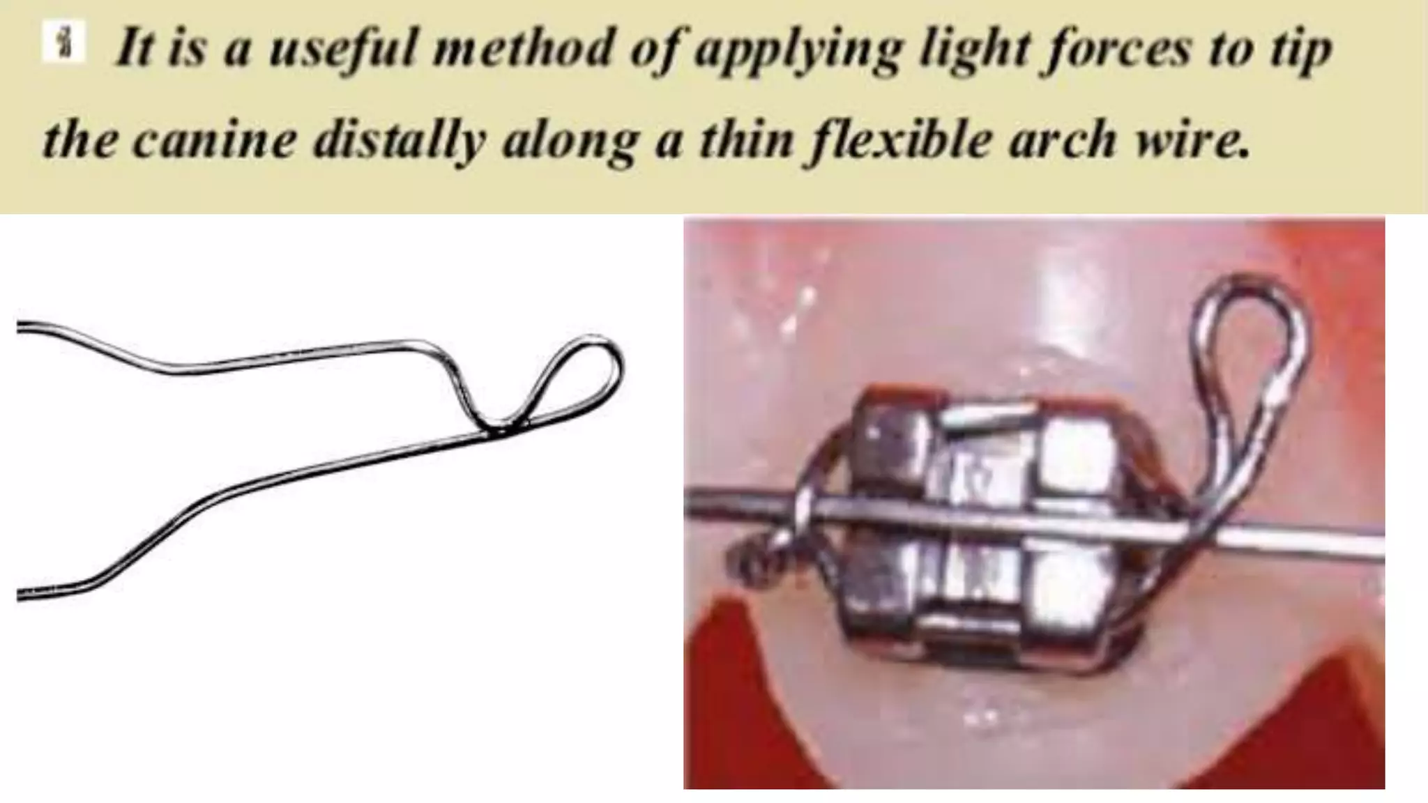 Methods of ligation | PPTX