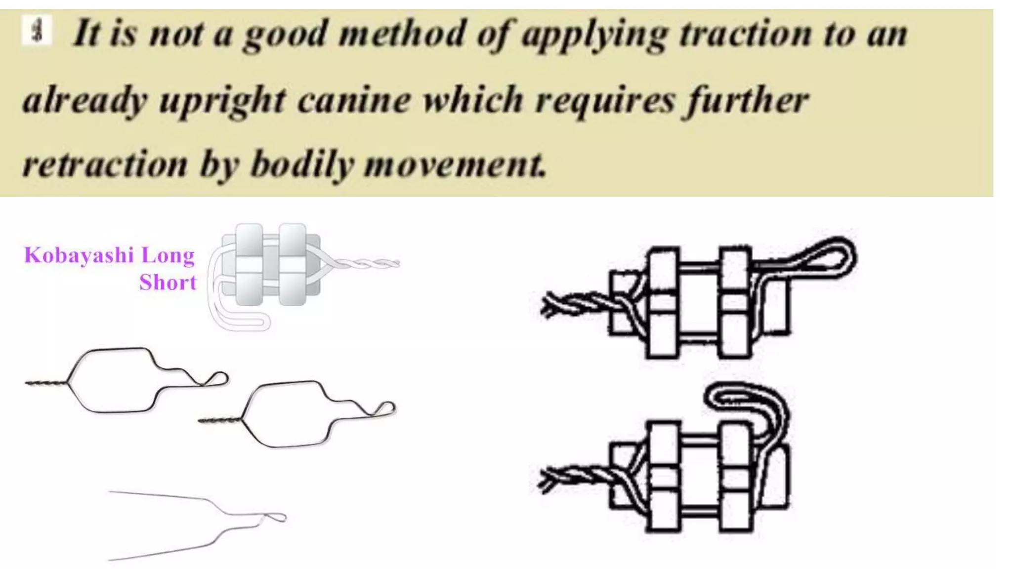 Methods of ligation | PPTX