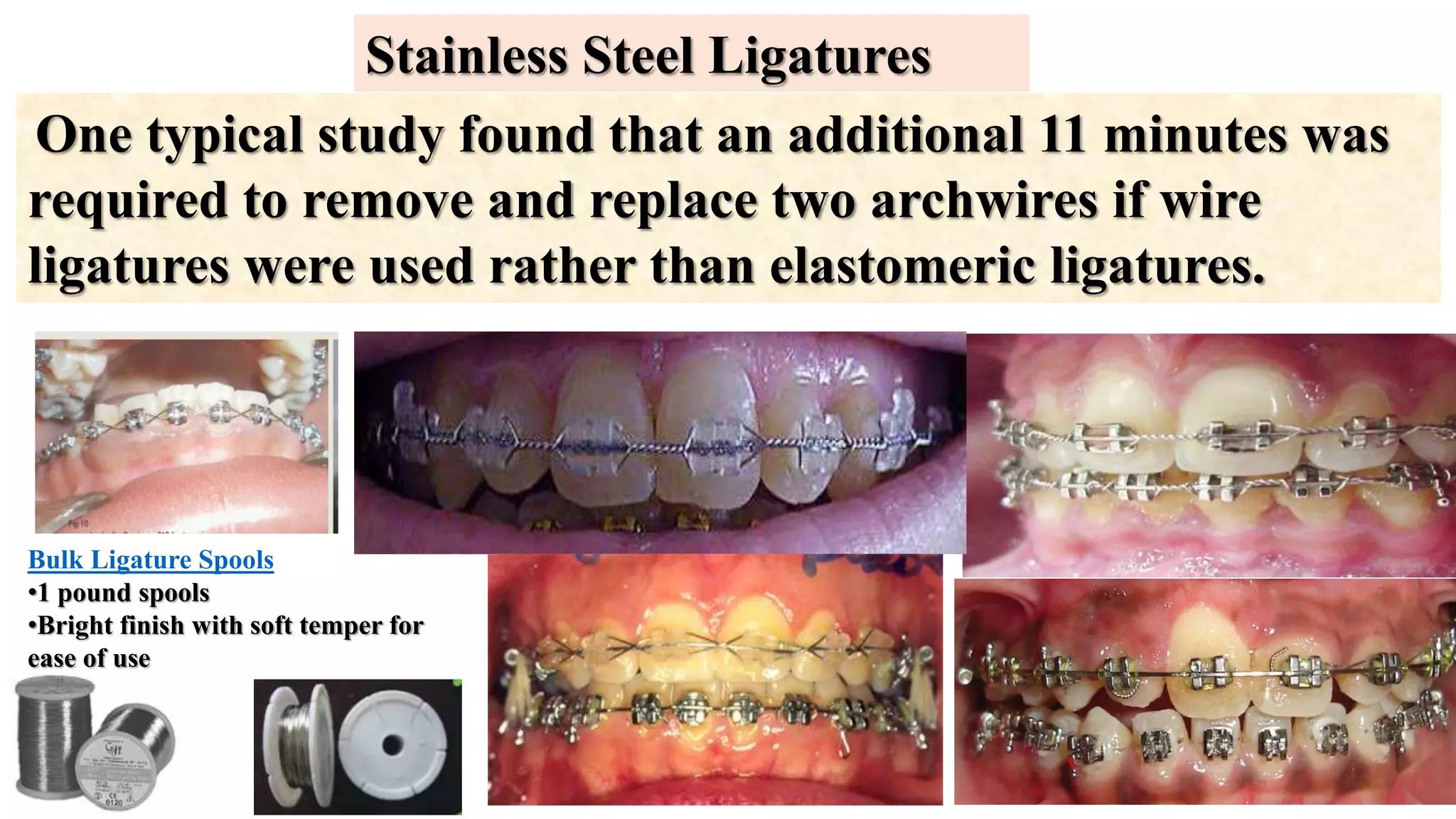 Methods of ligation | PPTX