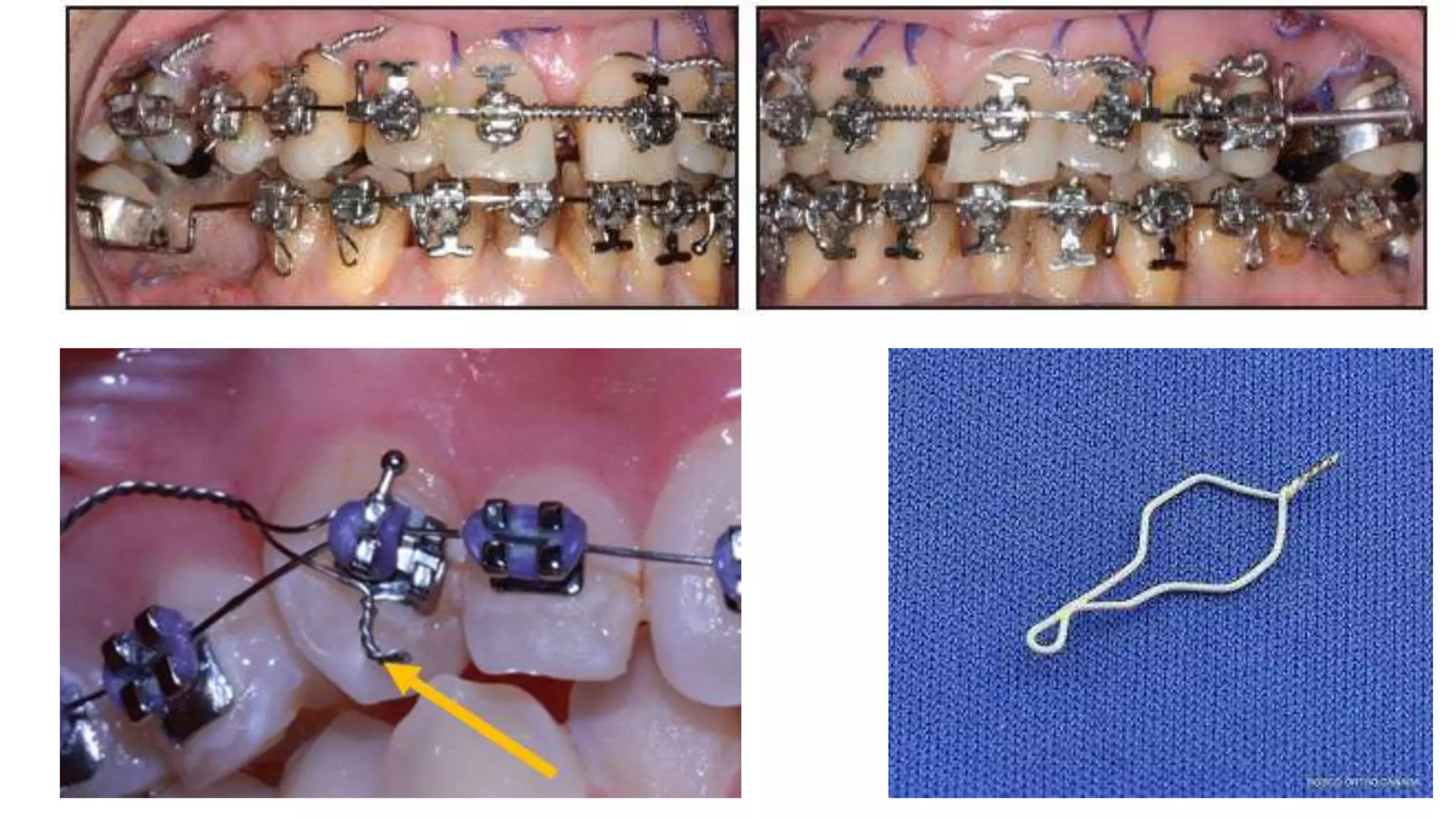 Methods of ligation | PPTX