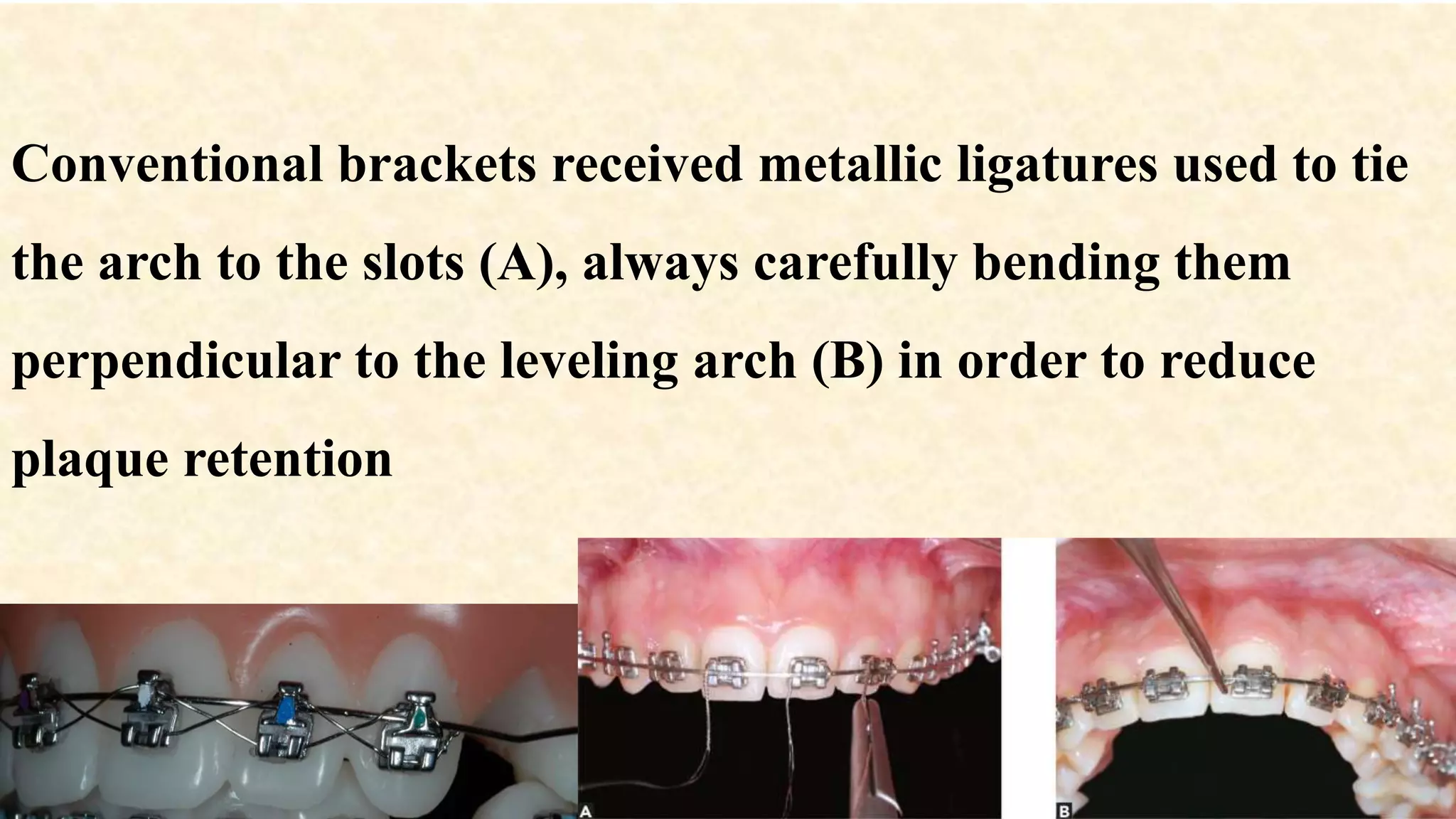 Methods of ligation | PPTX