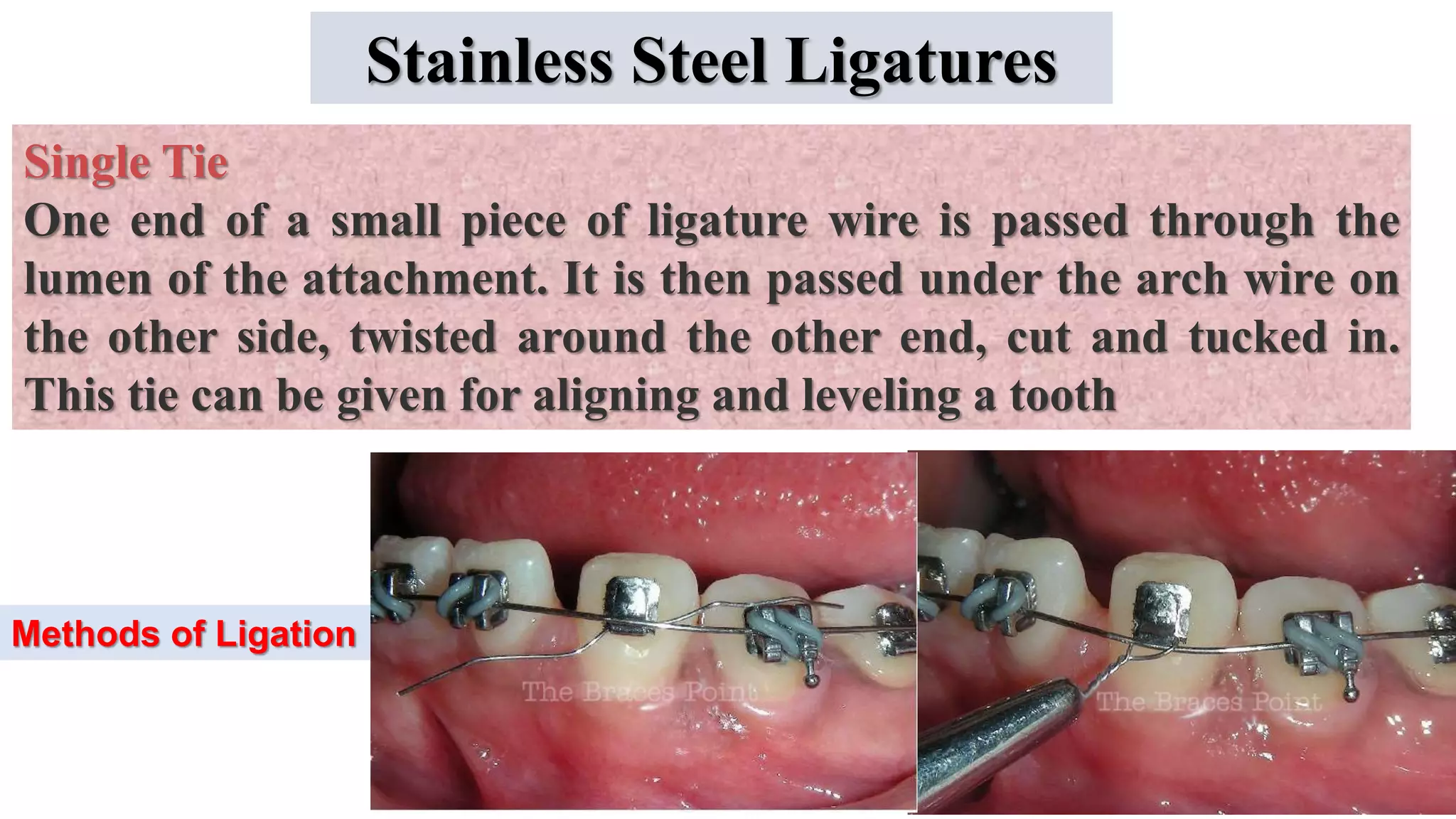 Methods of ligation | PPTX