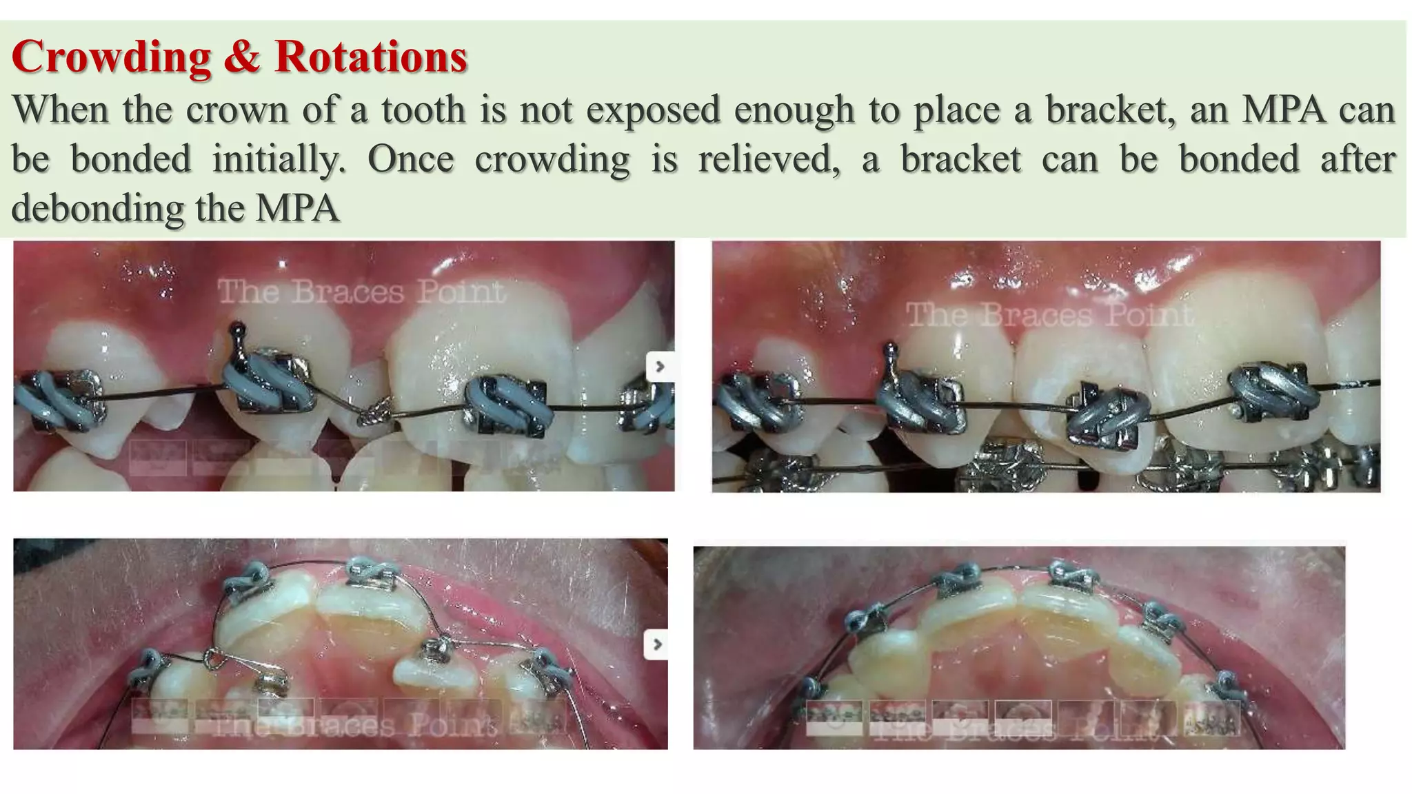 Methods of ligation | PPTX