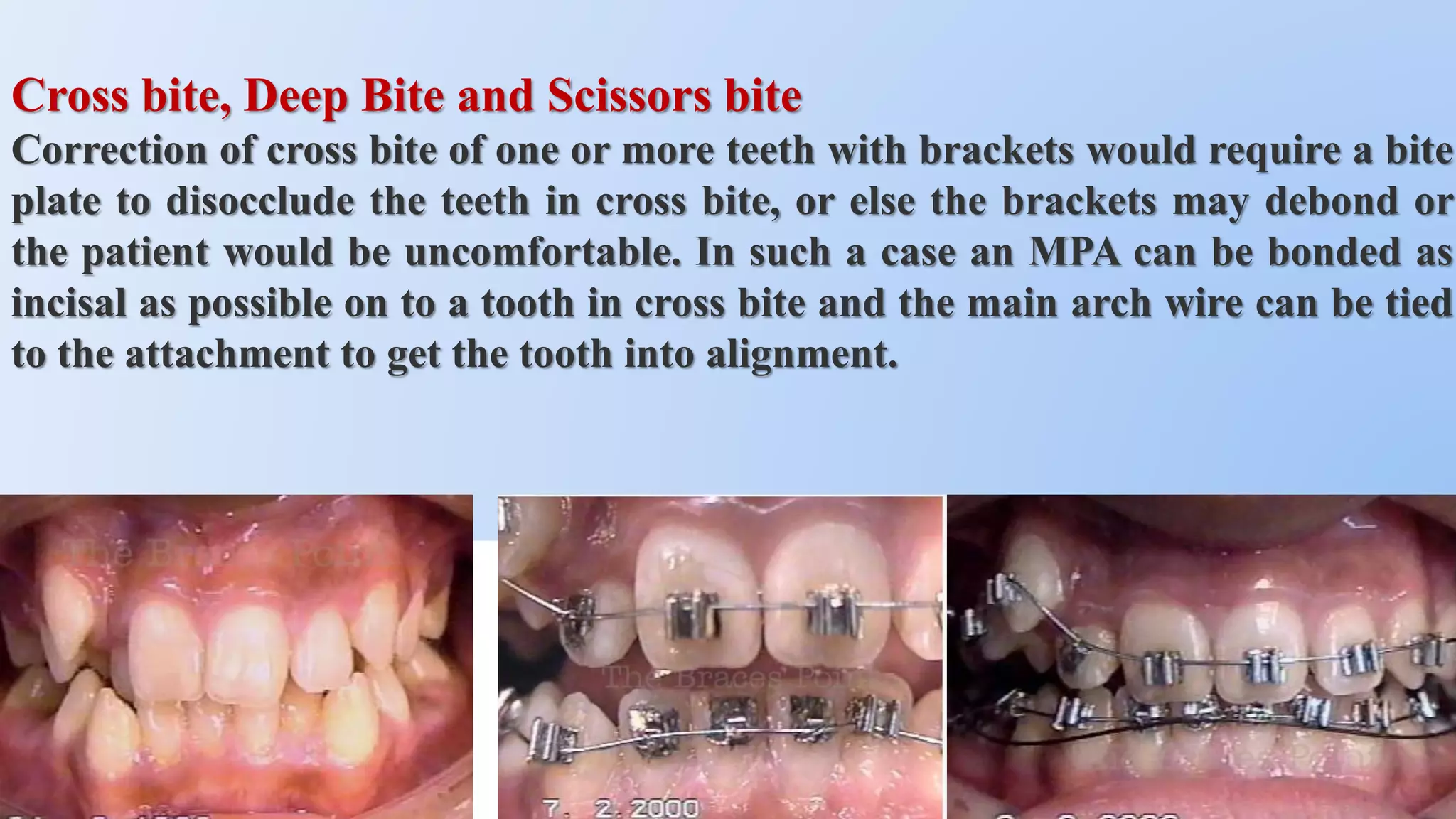 Methods of ligation | PPTX