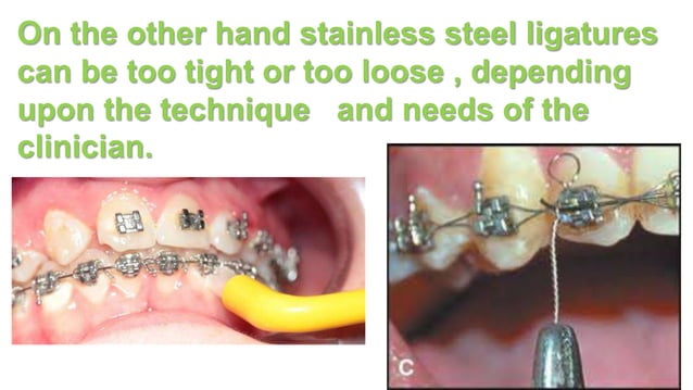 Methods of ligation | PPTX | Oral care | Personal Care