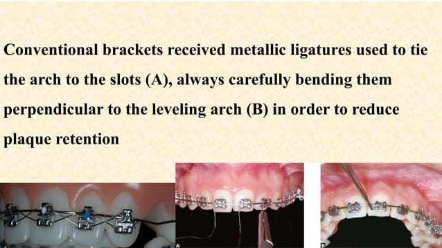 Methods of ligation | PPTX | Oral care | Personal Care