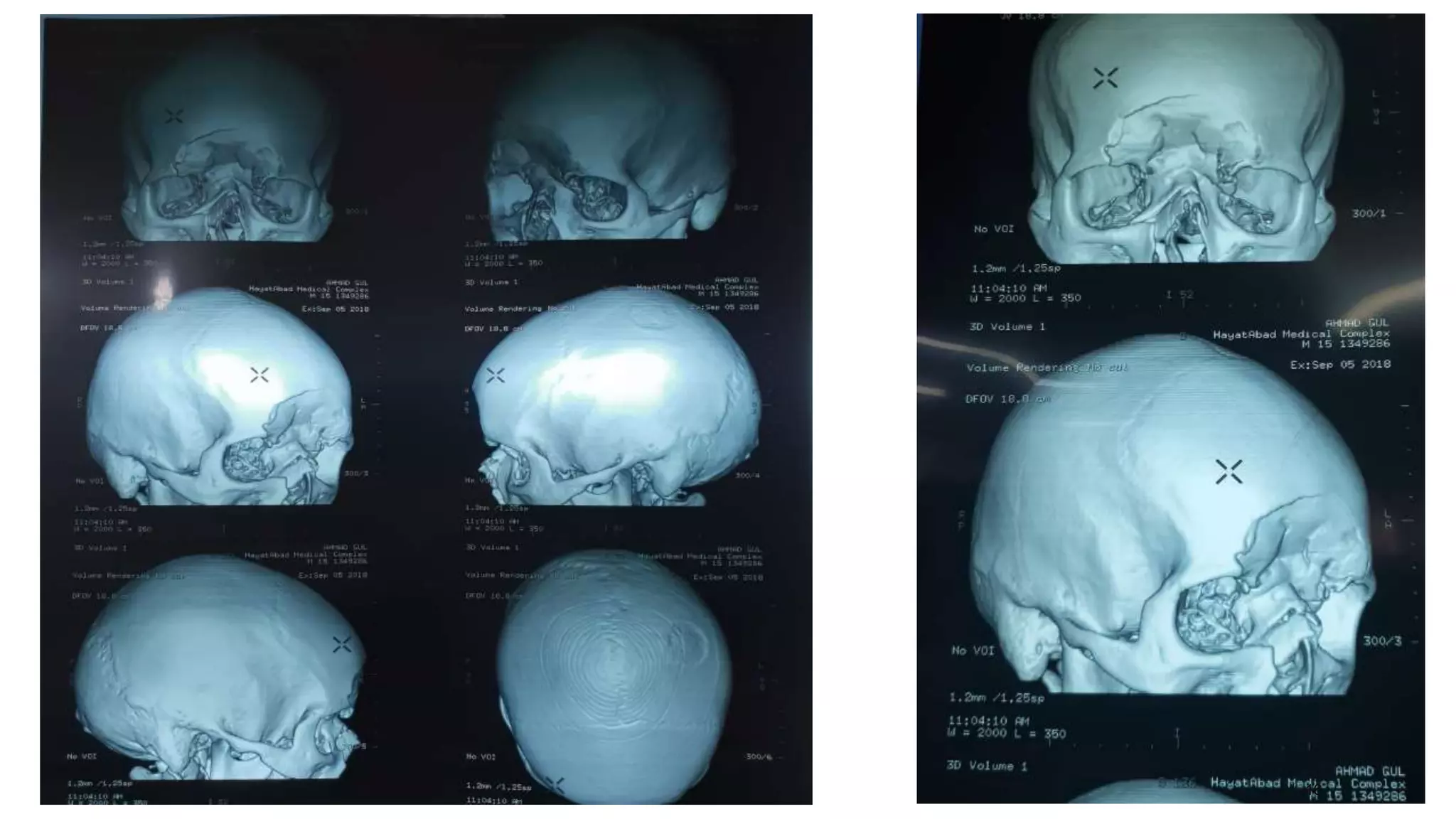 Case report Frontal Bone fracture - Junaid.pptx