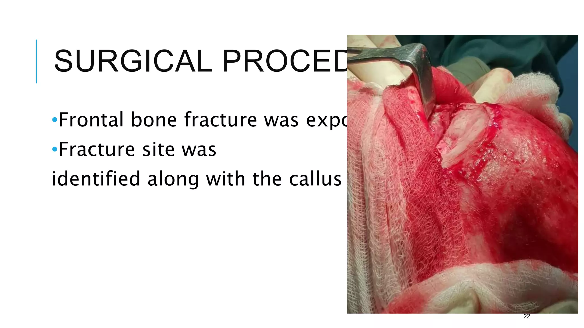 Case report Frontal Bone fracture - Junaid.pptx