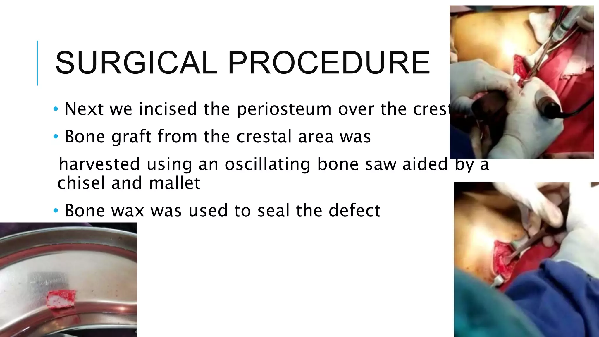 Case report Frontal Bone fracture - Junaid.pptx