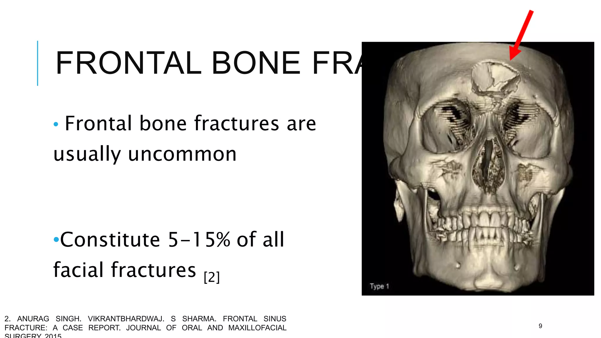 Case report Frontal Bone fracture - Junaid.pptx