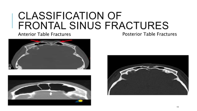 Case report Frontal Bone fracture - Junaid.pptx