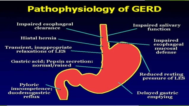 FINAL GERD.pptx | Digestive Disorders | Diseases and Conditions
