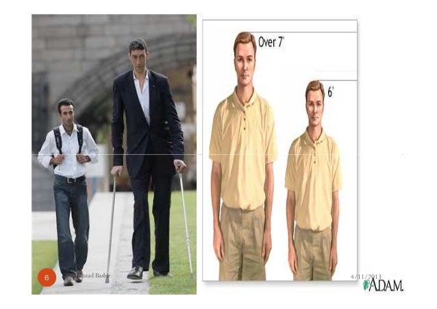 Gigantism And Acromegaly Endocrine And Metabolic