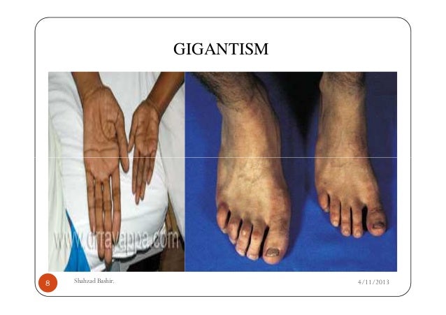 Gigantism And Acromegaly Endocrine And Metabolic