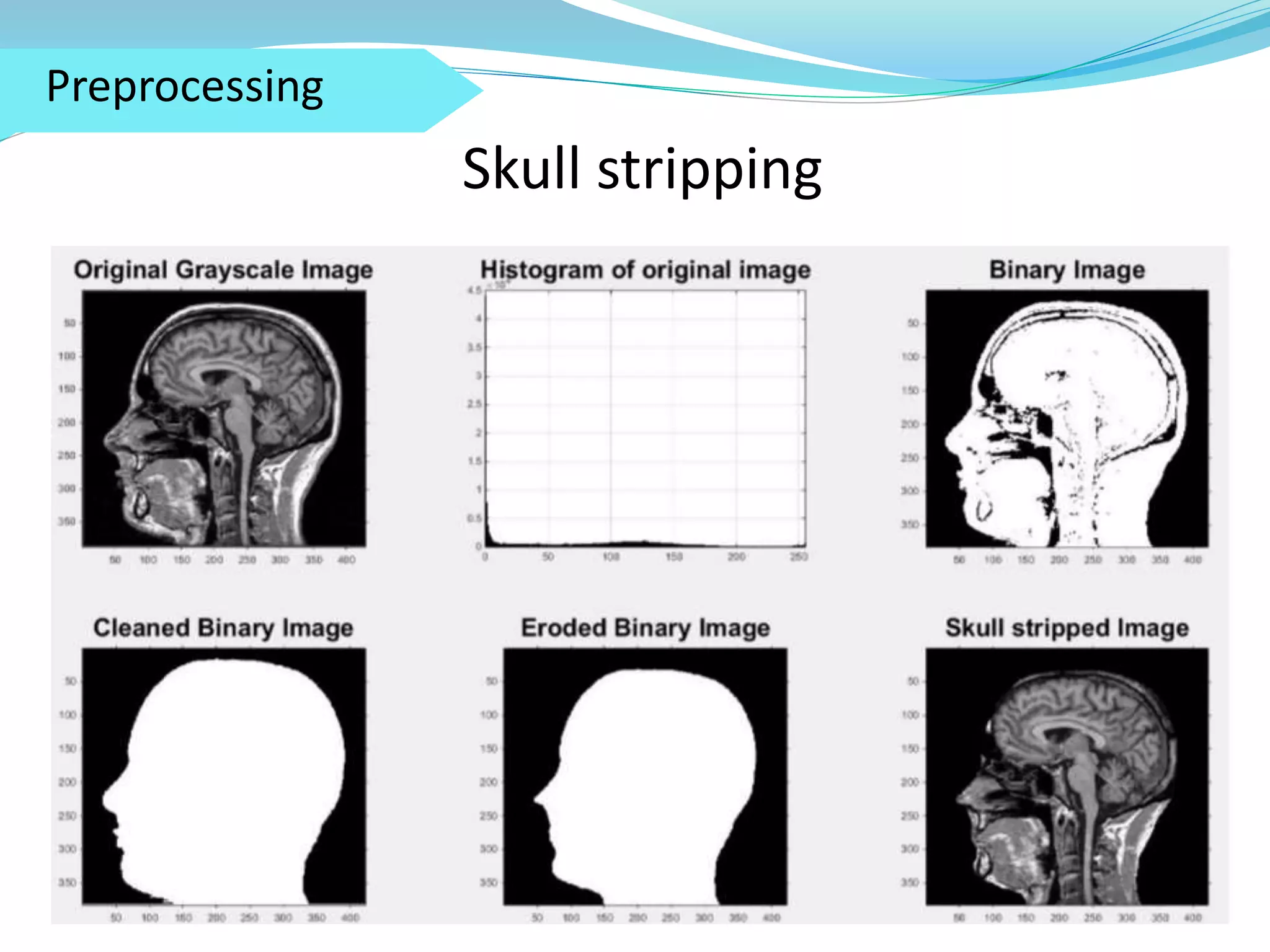 Automatic System For Detection And Classification Of Brain Tumors Ppt