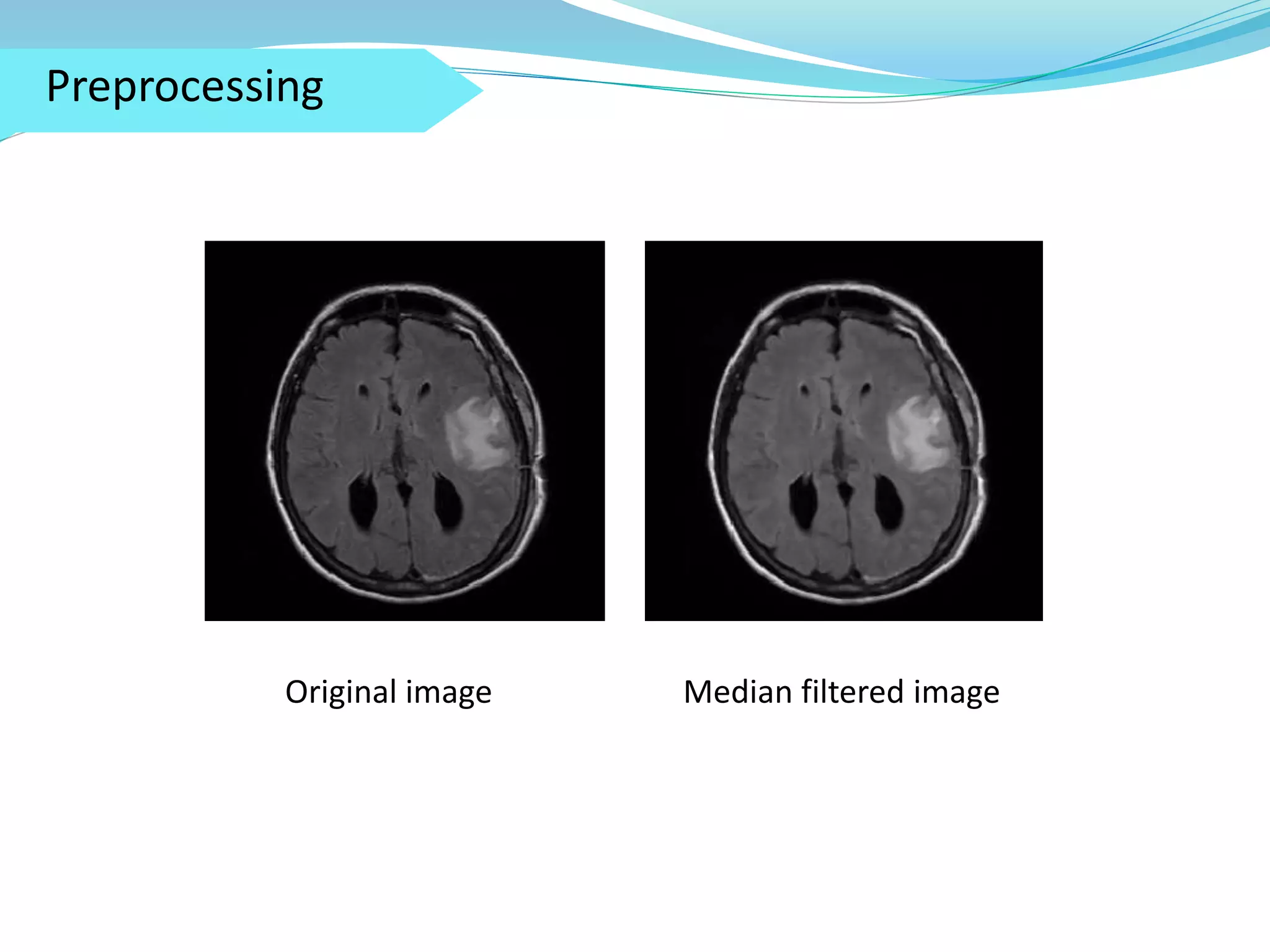 Automatic System For Detection And Classification Of Brain Tumors Ppt