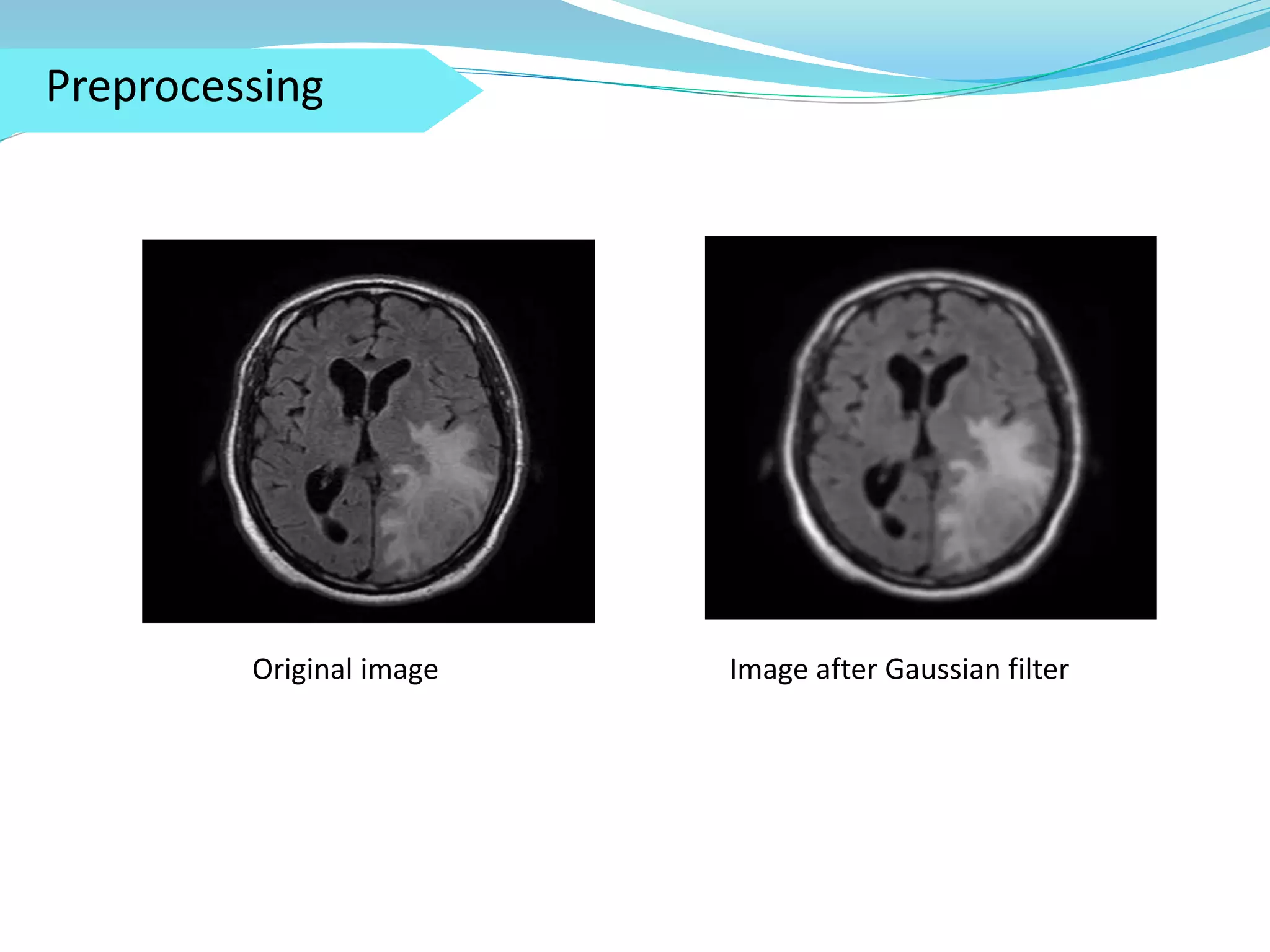 Automatic System For Detection And Classification Of Brain Tumors Ppt