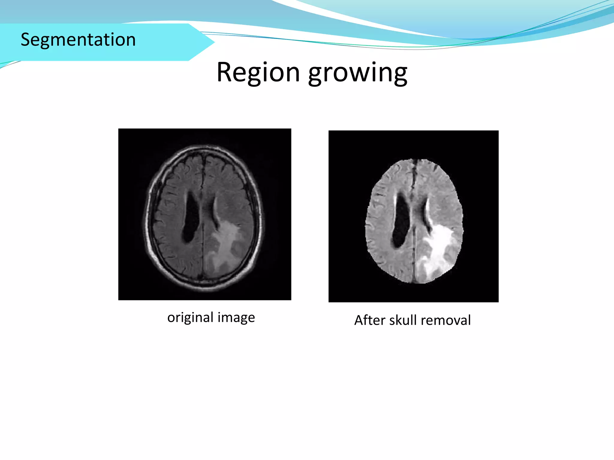 Automatic System For Detection And Classification Of Brain Tumors Ppt