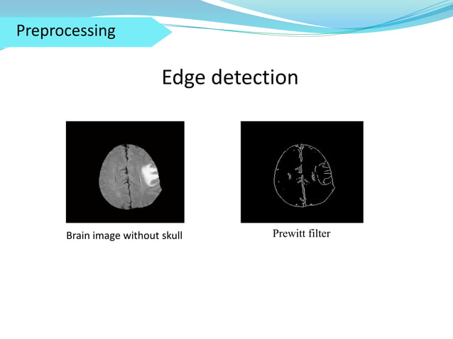 Automatic System For Detection And Classification Of Brain Tumors Ppt