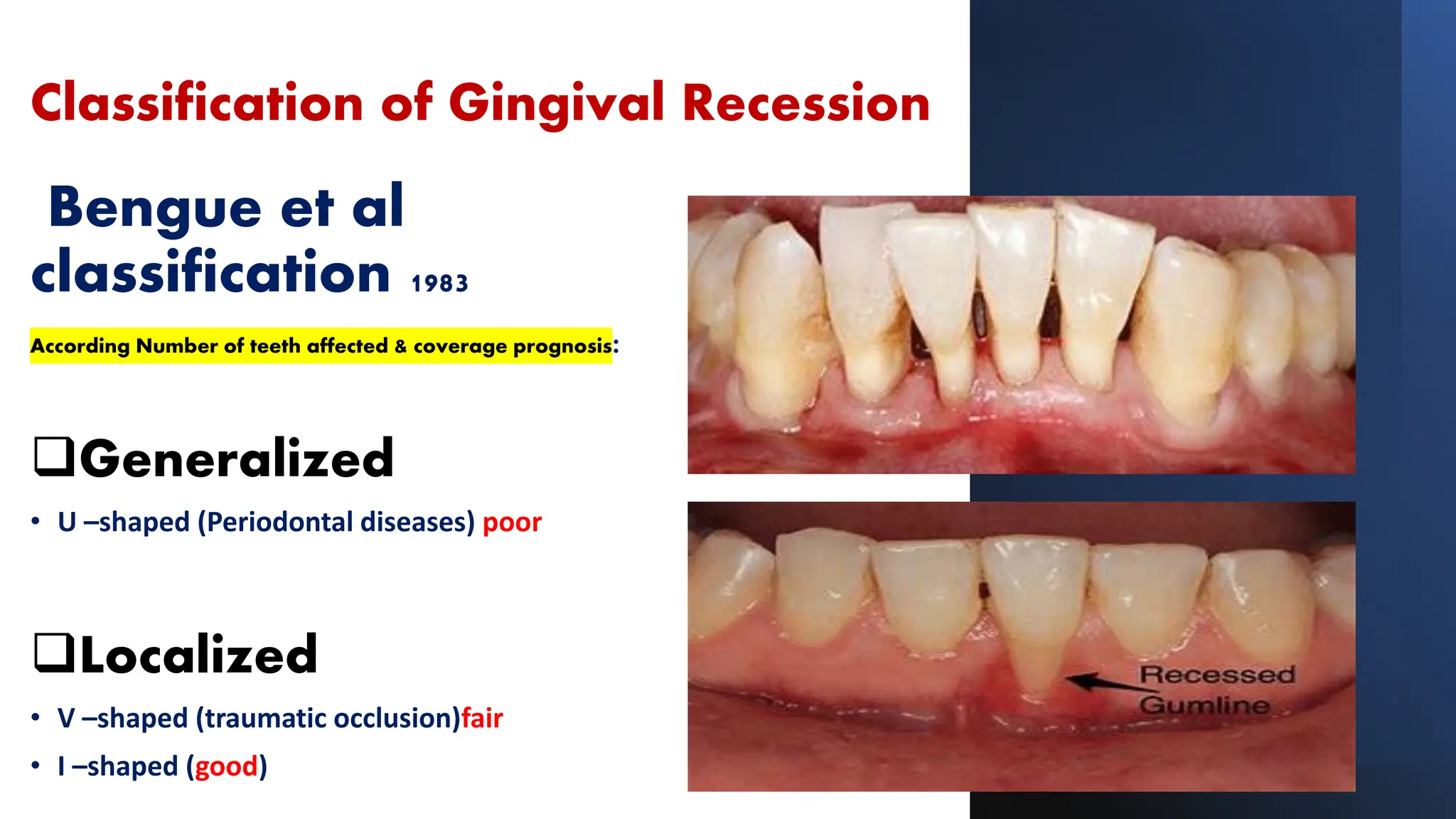 Art of predicting root coverage in localized gingival recession | PDF