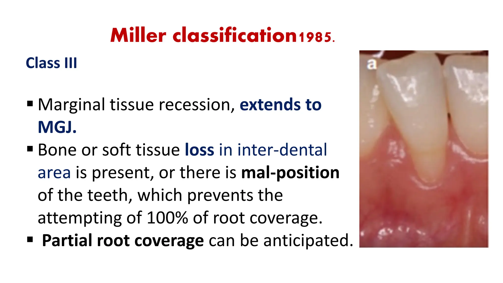 Art of predicting root coverage in localized gingival recession | PDF