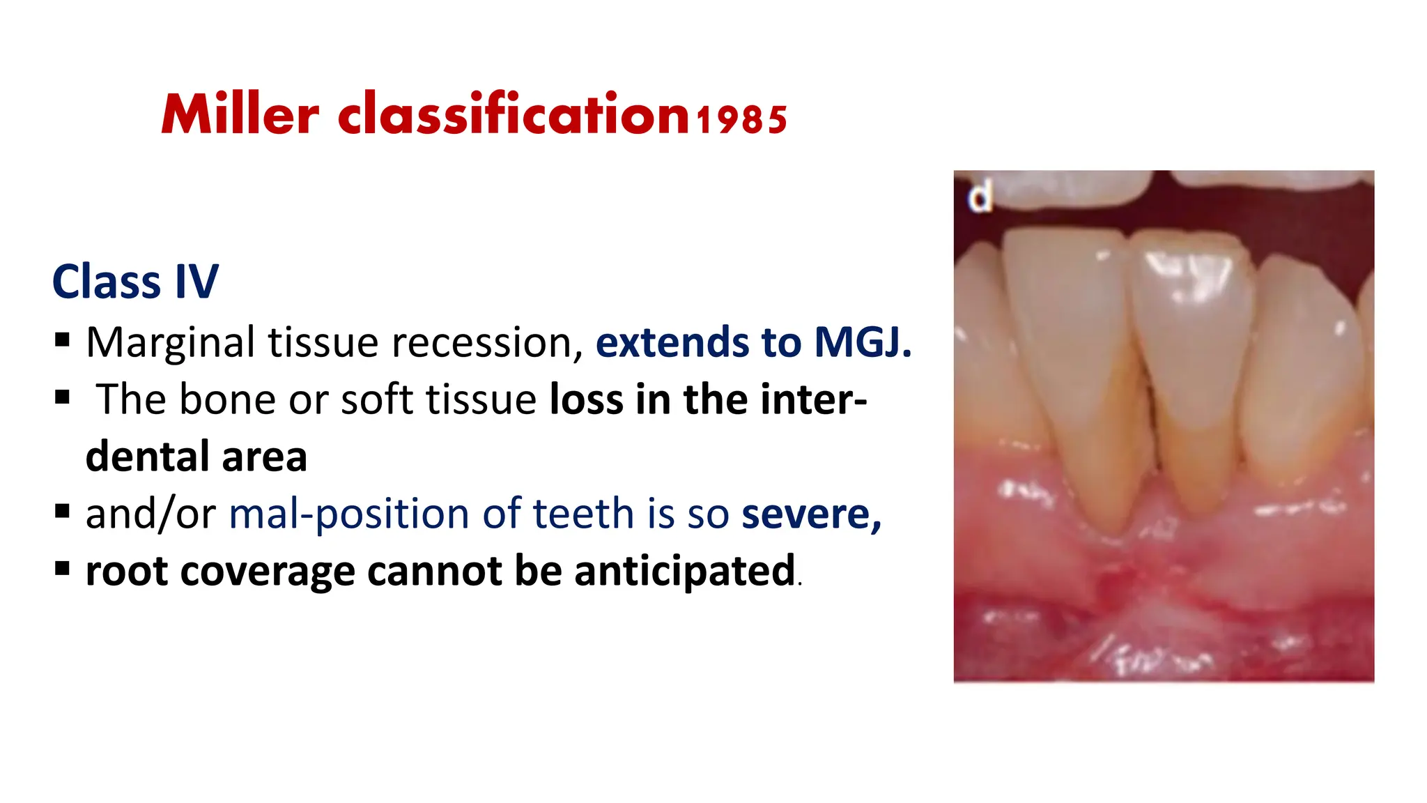 Art of predicting root coverage in localized gingival recession | PDF