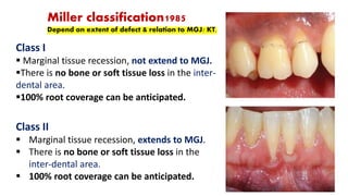 Art of predicting root coverage in localized gingival recession | PDF