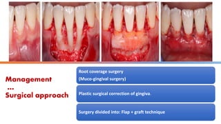 Art of predicting root coverage in localized gingival recession | PDF