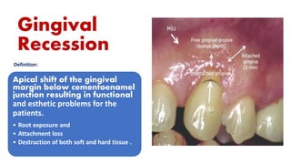 Art of predicting root coverage in localized gingival recession | PDF