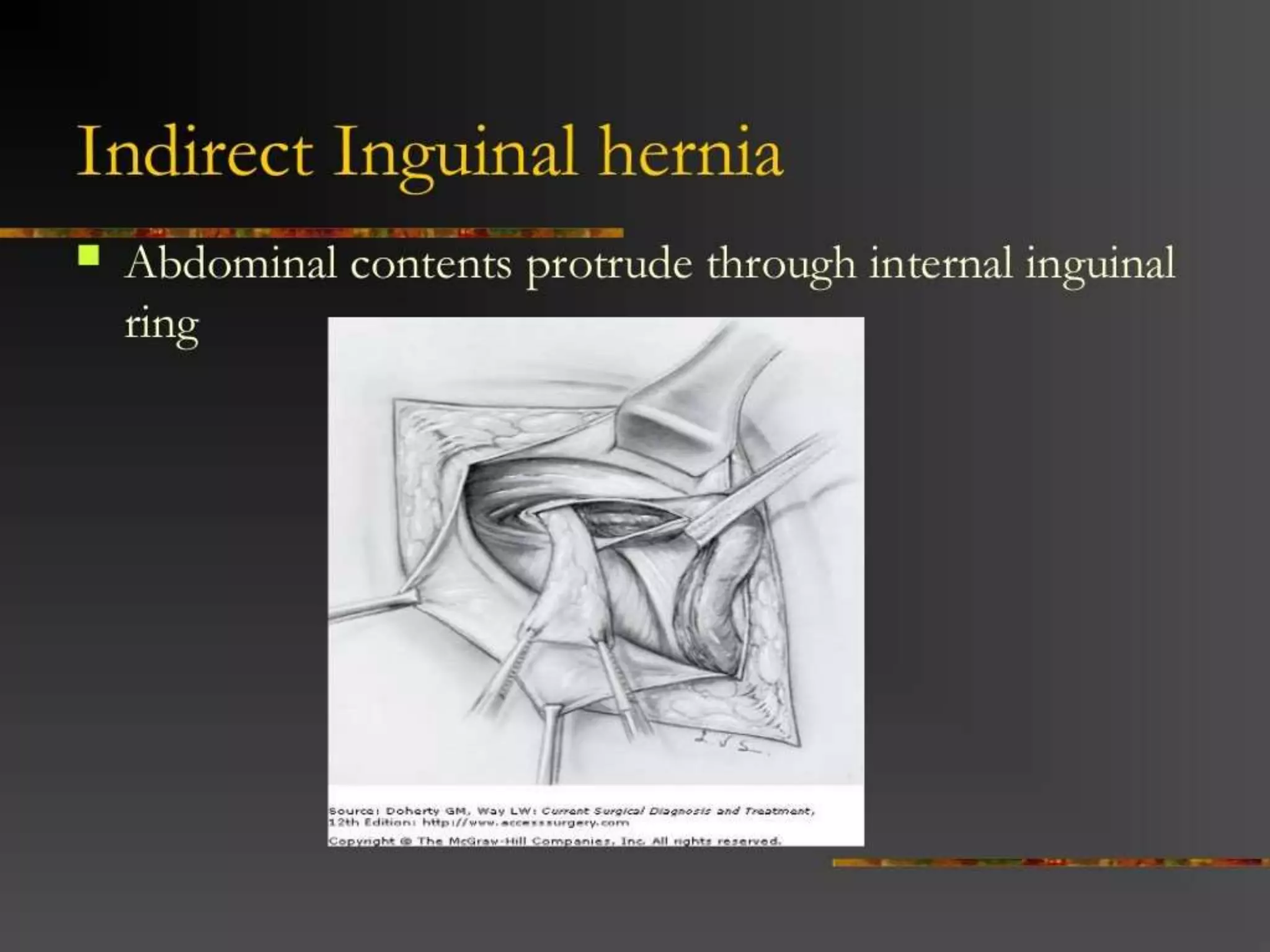 INGUINAL HERNIA HERNIA.ppt