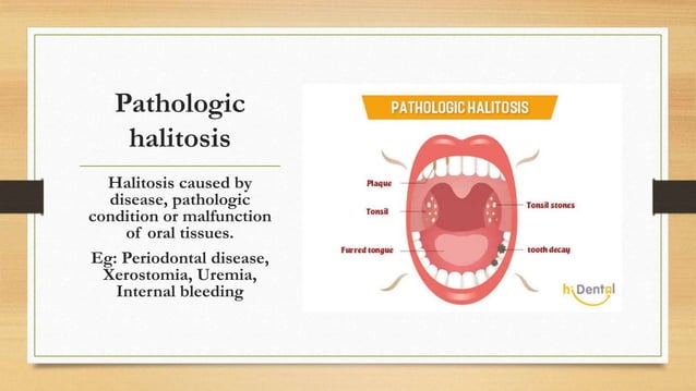 HALITOSIS_ diagnosis and management of halitosis | PPTX | Ear, Nose and ...
